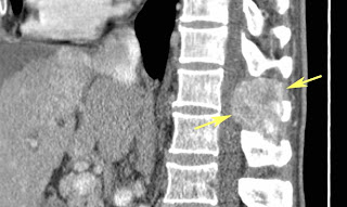 RiT radiology: Solitary Vertebral Metastasis Involving the Spinous Process