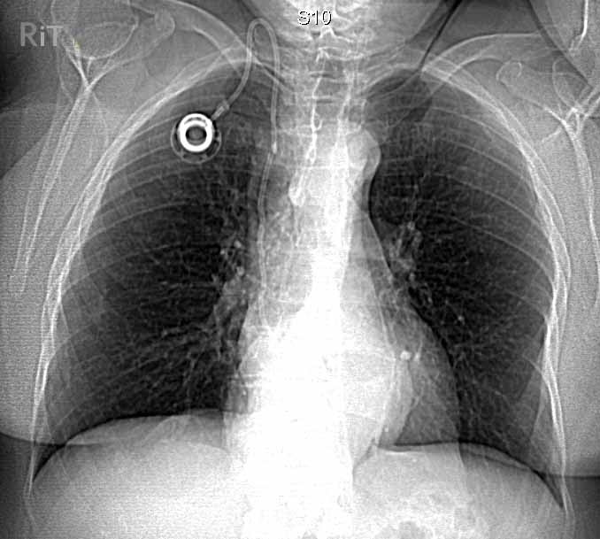 RiT radiology: Double Aortic Arch