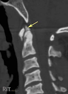 RiT radiology: Os Terminale - Os Odontoideum Complex (2)