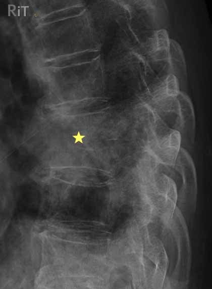 RiT radiology: Discitis-Osteomyelitis