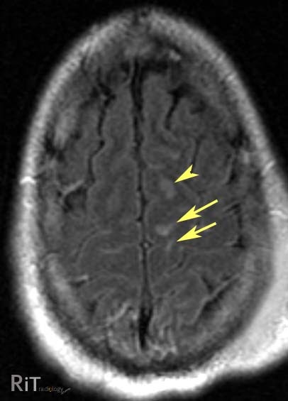 RiT radiology: Diffuse Axonal Injury