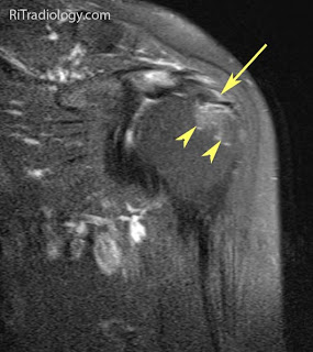RiT radiology: Rim-rent Tear of Supraspinatous Tendon