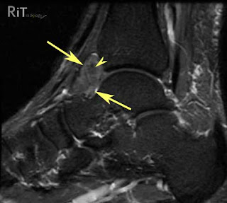 RiT radiology: Pigmented Villonodular Synovitis (PVNS) of the Ankle