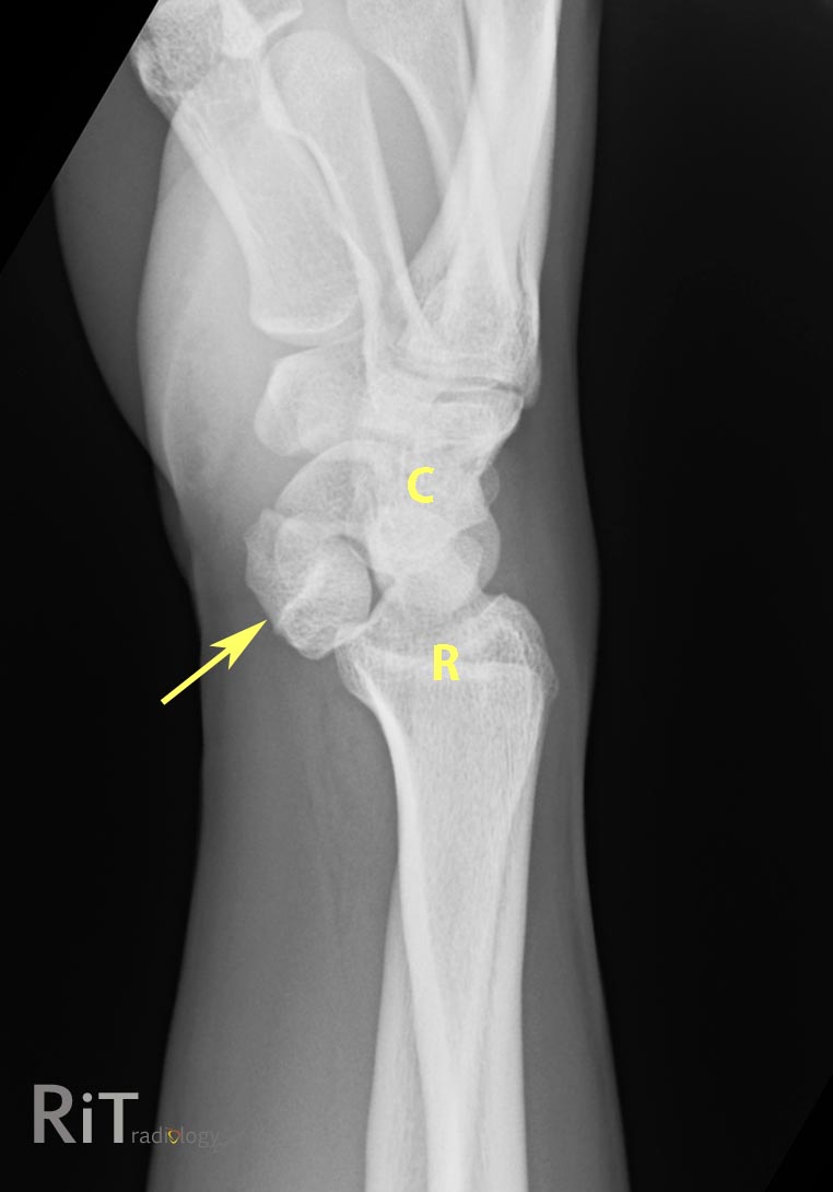 RiT radiology: Lunate Dislocation