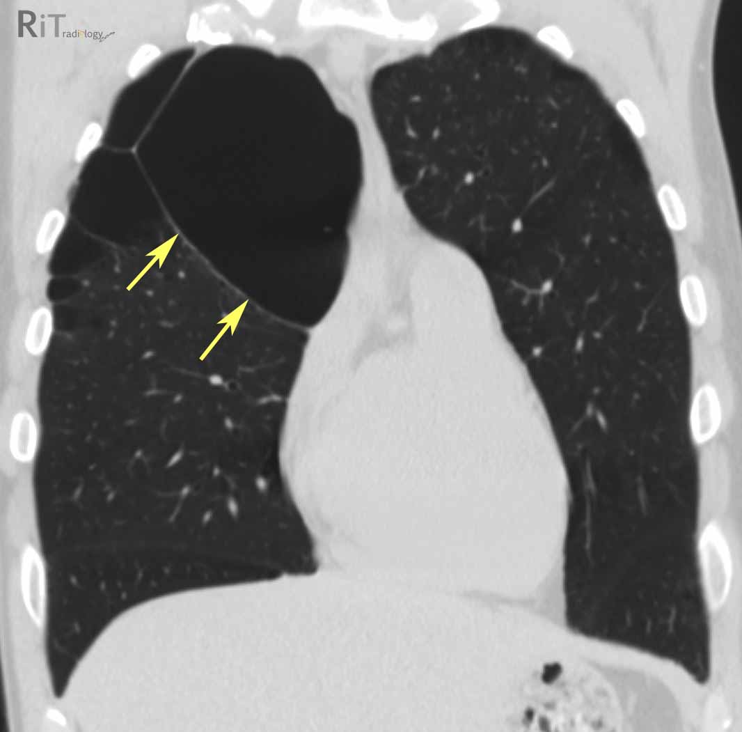 RiT radiology: Giant Bulla Vs. Pneumothorax