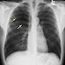 RiT radiology: Giant Bulla Vs. Pneumothorax