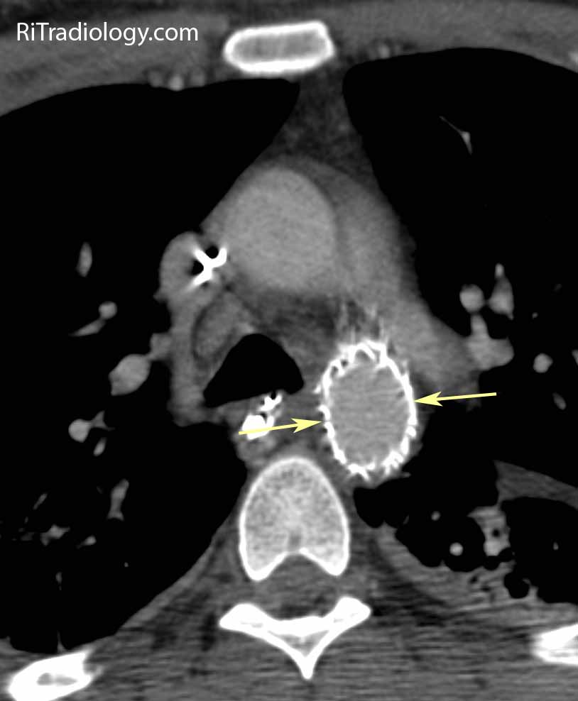 RiT radiology: Post-Endovascular Rx of Thoracic Aortic Injury