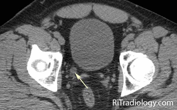 RiT radiology: Perinephric Stranding with Dilated Ureter