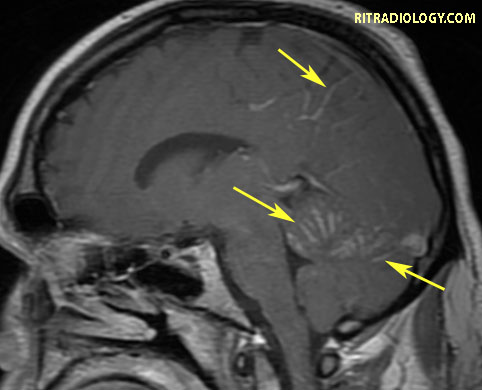 RiT radiology: Leptomeningeal Enhancement