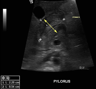 RiT radiology: Infantile Hypertrophic Pyloric Stenosis
