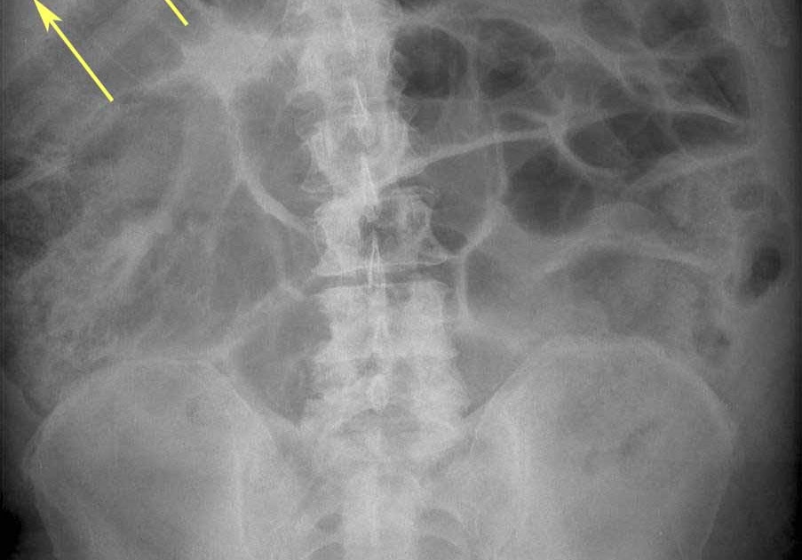 Rit Radiology Hepatic Portal Venous Gas