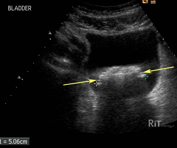 Bladder Stone Ultrasound