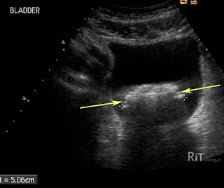 RiT radiology: Bladder Stones