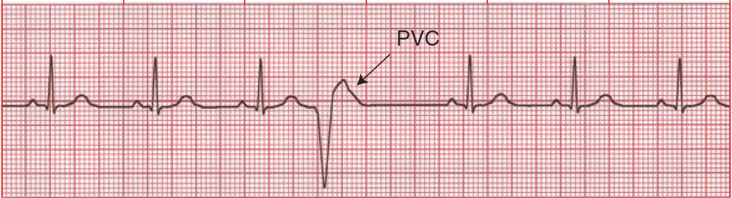 Premature Ventricular Contractions Pvc Boss Rn