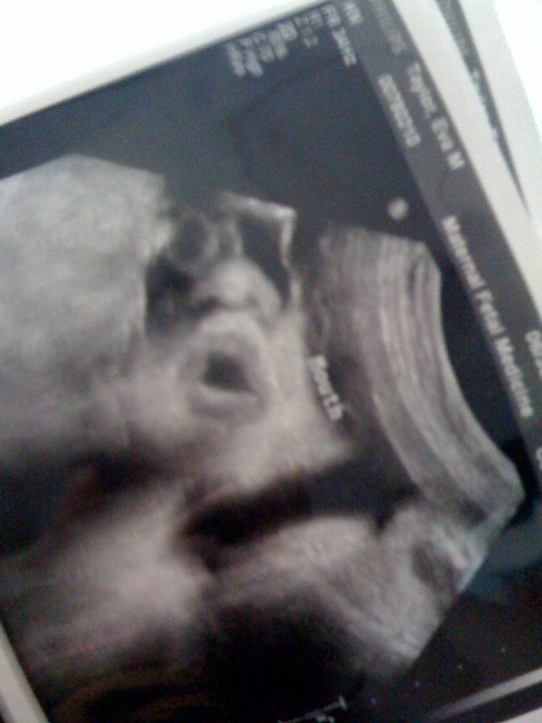 Letters to Stella Rose: Antepartum Support Group & Your 31 Week Ultrasound