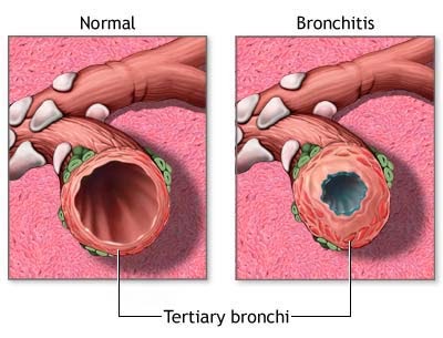 Leacuri din batrani: BRONSITA - AFECTIUNI ALE APARATULUI RESPIRATOR
