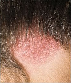 Alopecia-Calvicie y Enfermedades: ¿Cuáles son los síntomas de la tiña ...