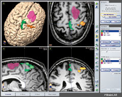 Gehirntumor Clivuschordom !: Brainlab iPlan® BOLD MRI Mapping