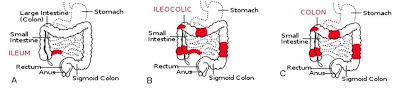 TooSogiE Health: CROHN’S DISEASE