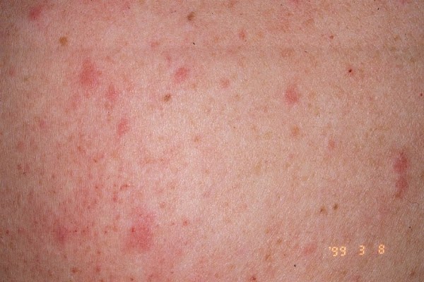 urticária colinérgica - Geri e Derme Beauty