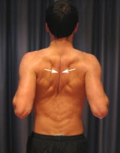 Ascent Physical Therapy: EXERCISE OF THE WEEK - Shoulder Blade Squeeze