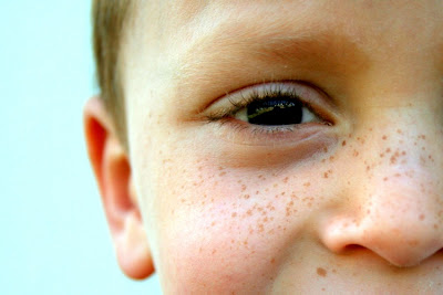 Capture Estilo: Sardas ou Efélides