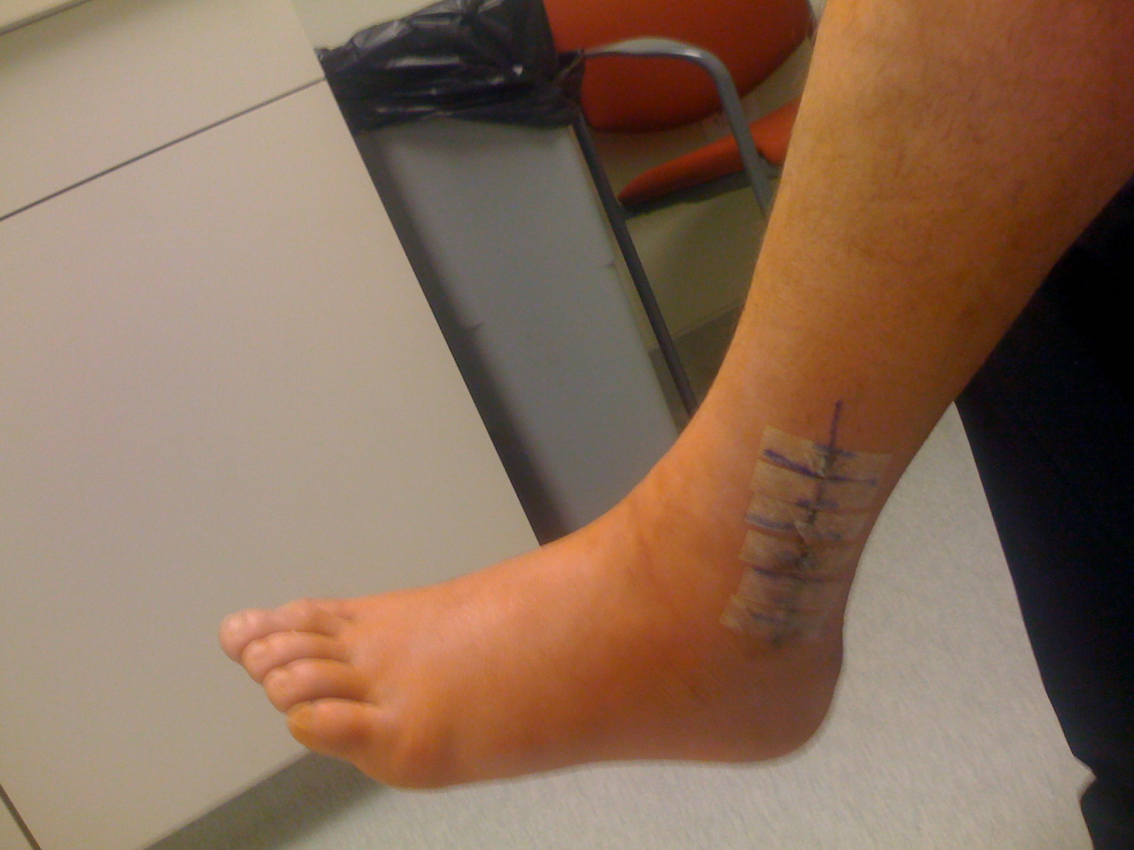 Roberts Family Broken Ankle