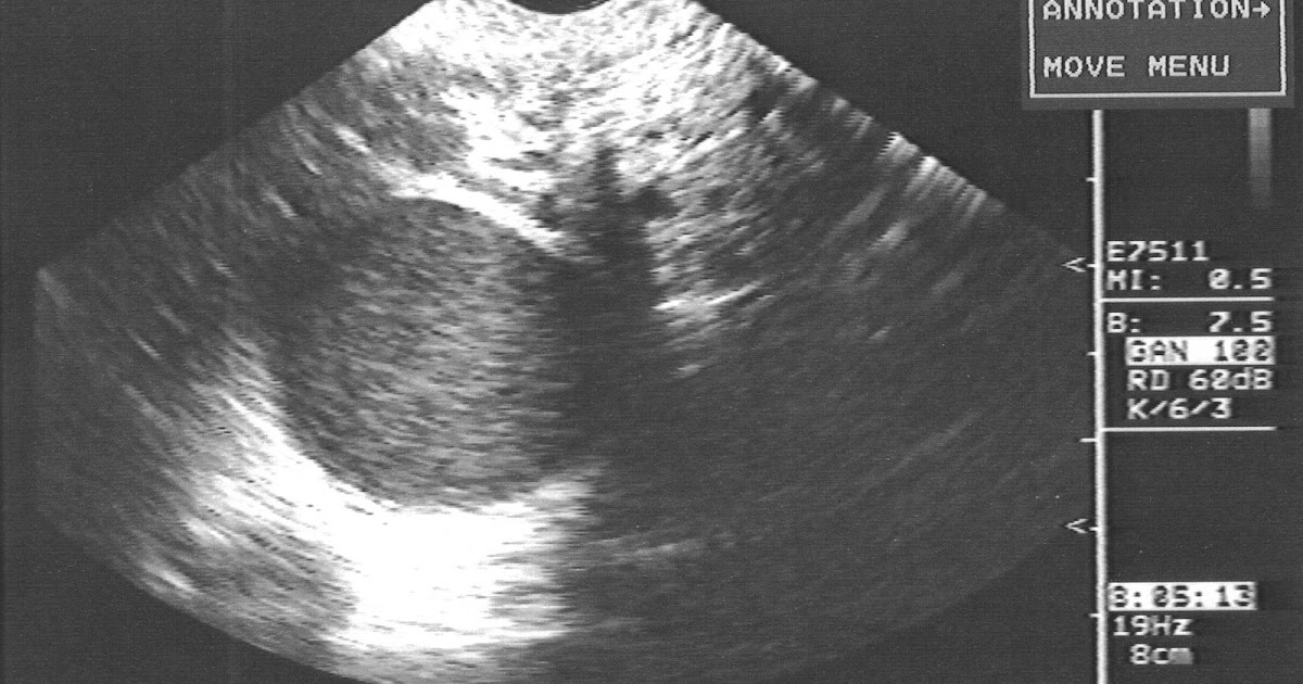 Diario de un Medico II: Quiste Dermoide