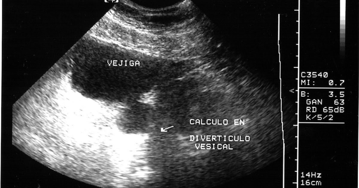 Diverticulo Vesical