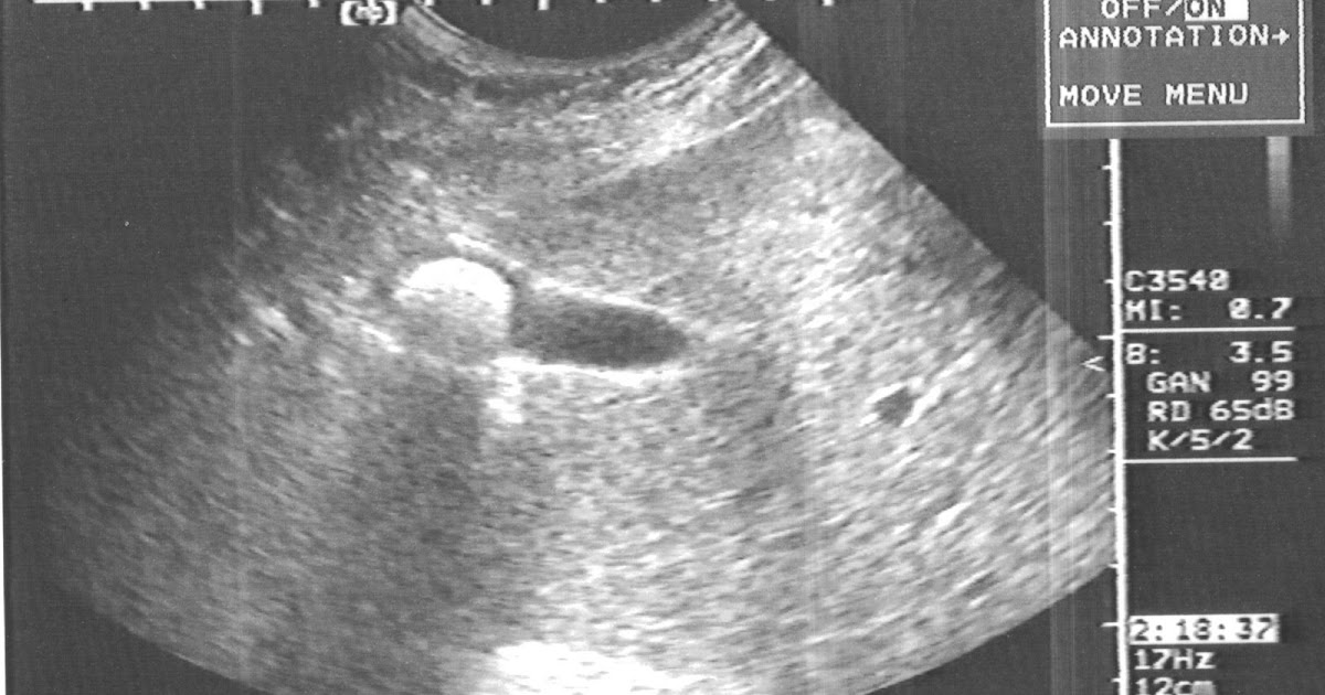 Calculo Unico Vesicula