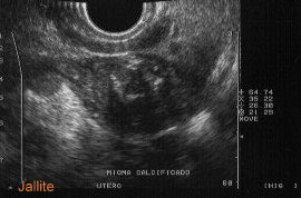 Mioma Uterino Calcificado