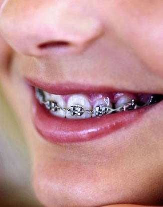 behel jadi trend: behel