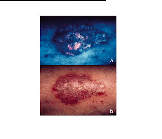 samarth: Wood's lamp lesion