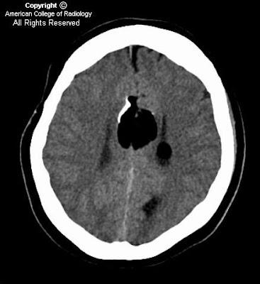 Holoprosencephaly: Corpus callosum lipoma, Agenesis of the corpus ...