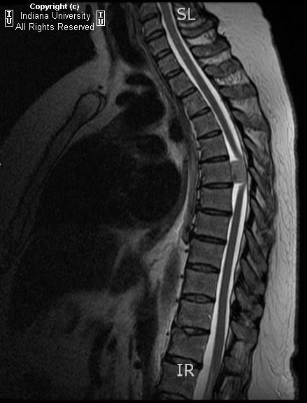 Neuroradiology On The Net Spinal Meningioma