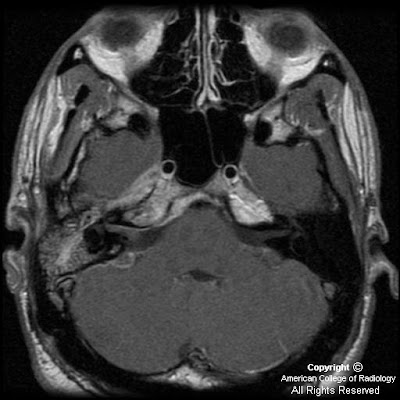 Neuroradiology On the Net: Gradenigo syndrome