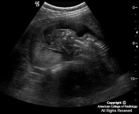 Neuroradiology On the Net: Acrania