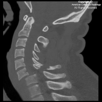 Neuroradiology On the Net: Bilateral jumped facets with spinal cord ...
