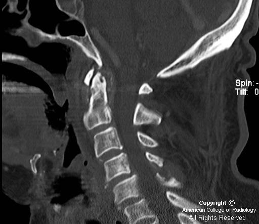 Neuroradiology On the Net: CPPD of the cervical spine - "crown dens ...