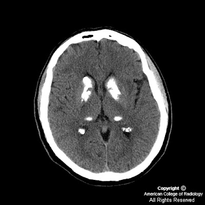 Calcification In Brain