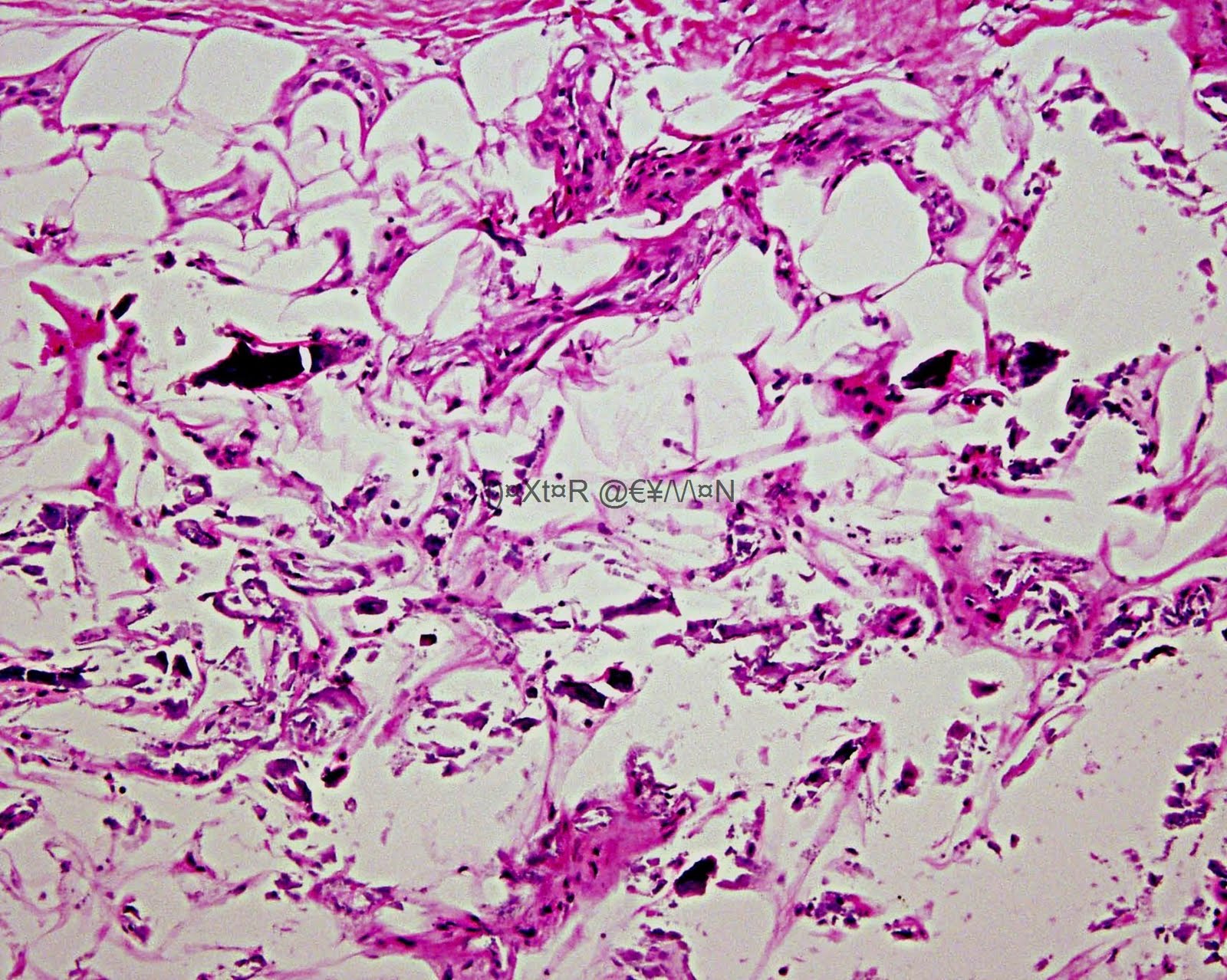 Liver Cancer: Untreated Liver Cancer Prognosis