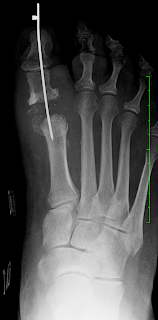 Cleveland Foot and Ankle Case Blog: Case: 1st MPJ Implant Failure