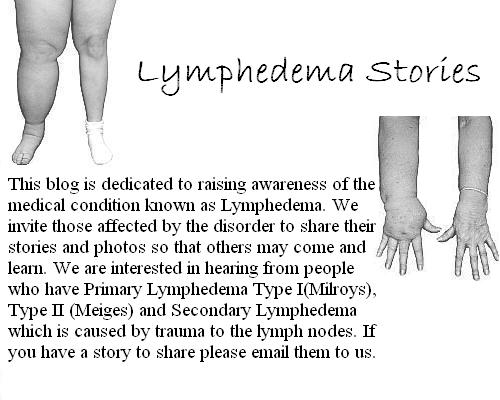 Lymphedema Stories: Our Story: Infant Son Diagnosed with Primary Lymphedema