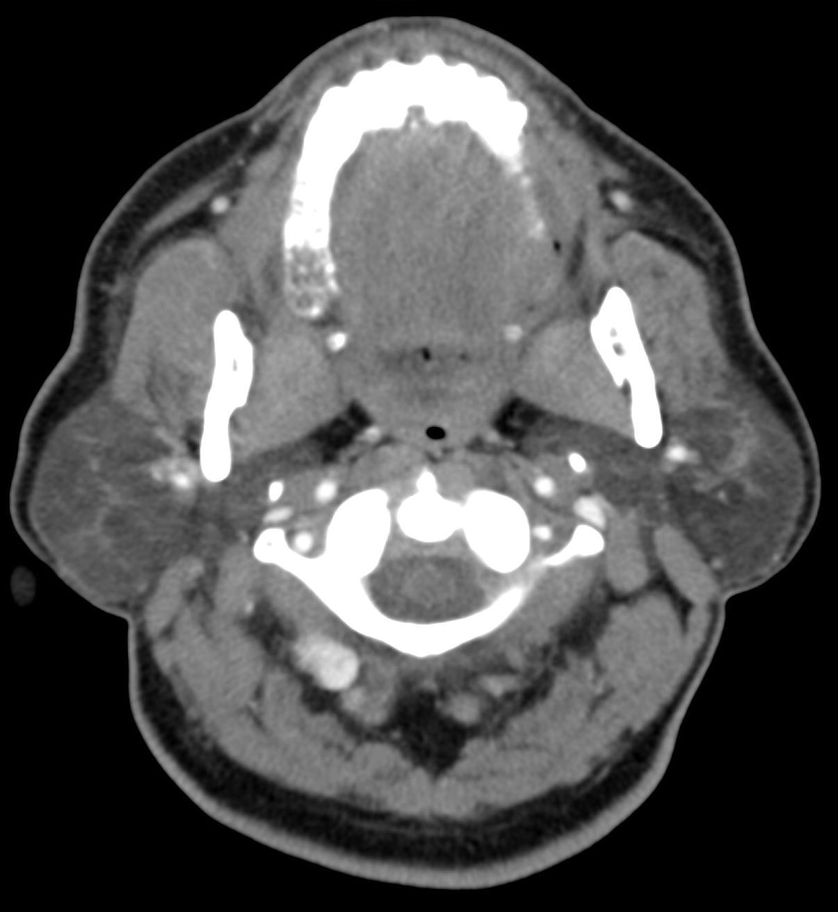 BLOG SCAN - RA Radiologistas Associados: SIALOADENOSE ( SIALOSIS )