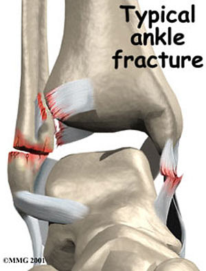 Meriden CT Podiatrist: Ouch! Ankle Fractures