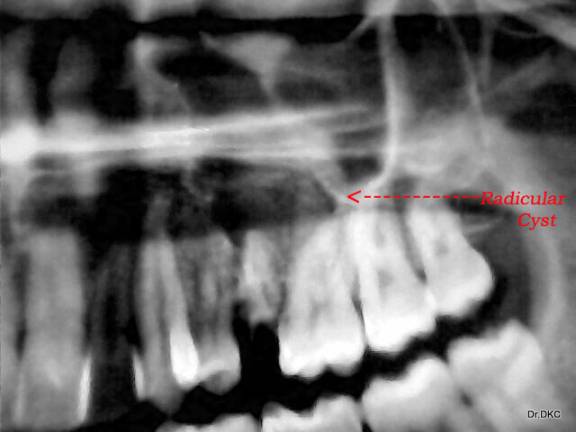 Radicular Cyst: Apical periodontal Cyst in a 27 years old male.