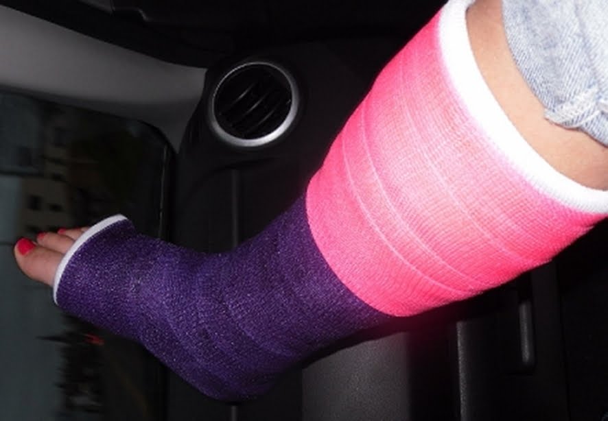 Casts and Toes: Some nice Leg Cast Pics