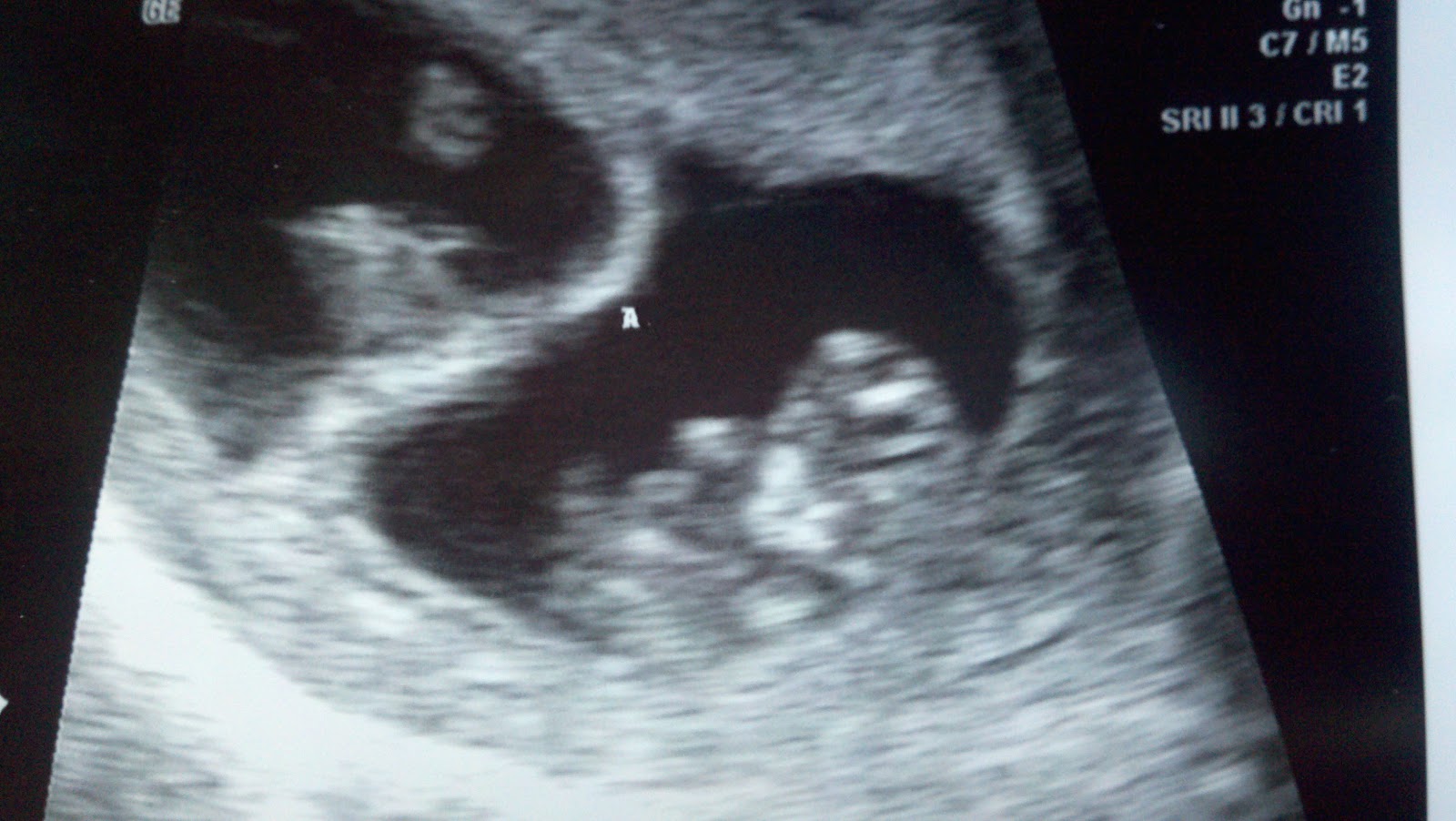 The Wright Twins: Weeks 6 and 9 Ultrasounds and Week 9 Belly Pic