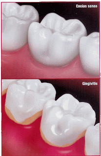 higiene bucodental tenerife: ¿Cómo es la encía sana?