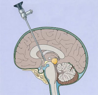 Our Life And Such: The Third Ventriculostomy